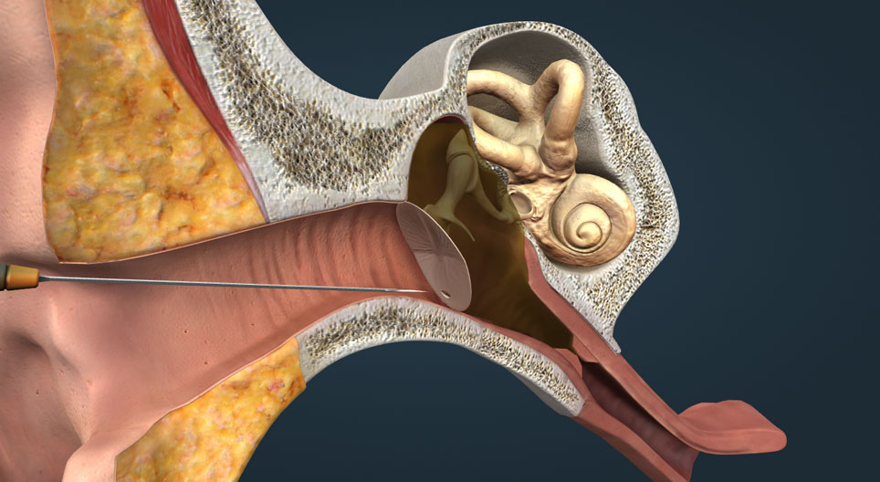 Middle ear infection, otitis media - 3D scene - Mozaik Digital ...