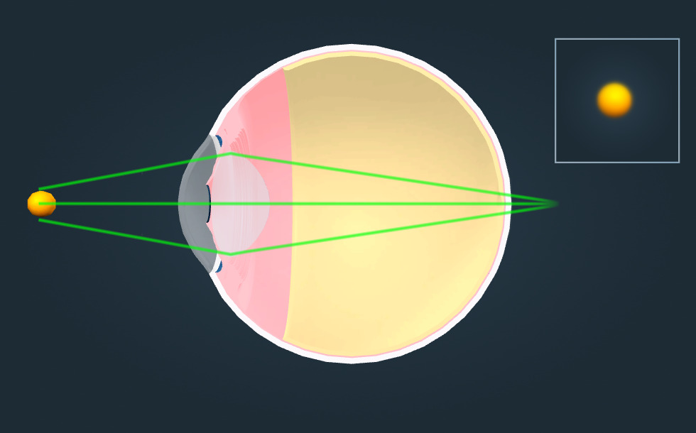 Vision correction - 3D scene - Mozaik Digital Education and Learning