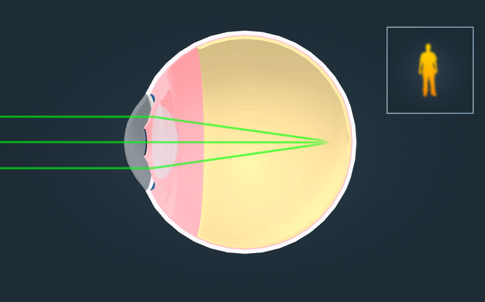Vision correction - 3D scene - Mozaik Digital Education and Learning