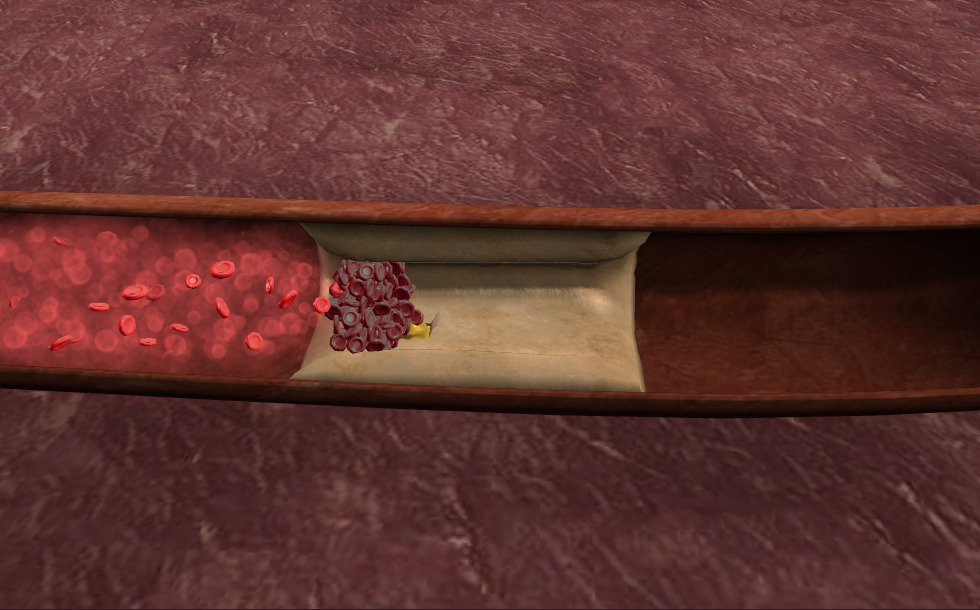 Heart attack - 3D scene - Mozaik Digital Education and Learning