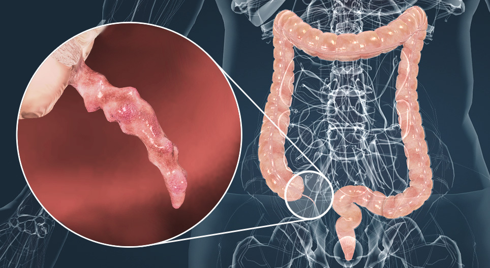Appendicite - scena 3D - Insegnamento e apprendimento digitale Mozaik