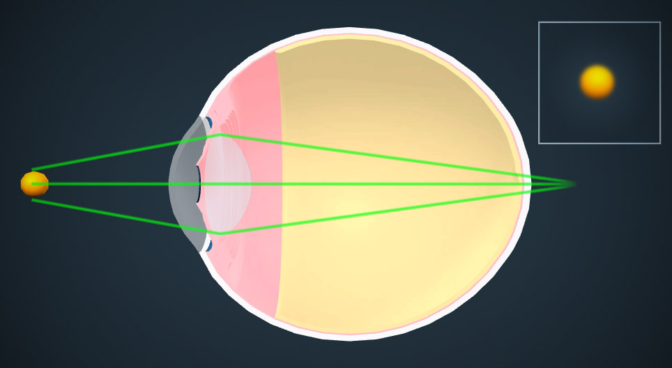 Vision correction - 3D scene - Mozaik Digital Education and Learning