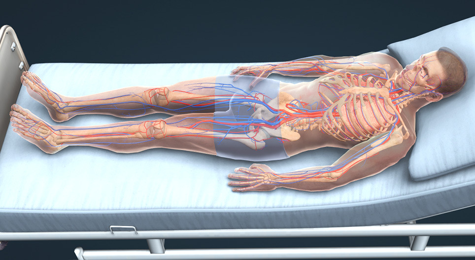 Dyp venetrombose og lungeemboli - 3D-scene - Mozaik Digital utdannelse ...